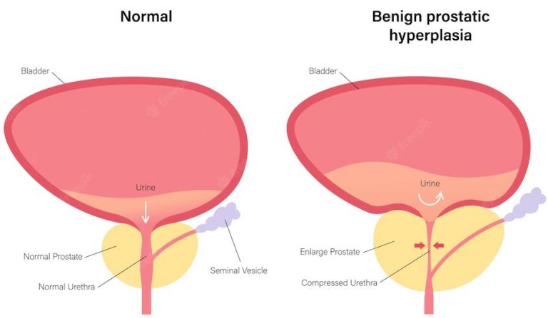 Information About Prostate. - BIMS Hospital
